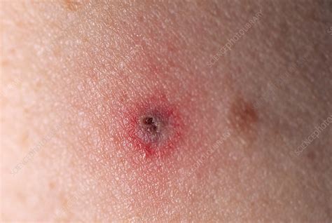 Lyme Disease Stock Image C003 1302 Science Photo Library