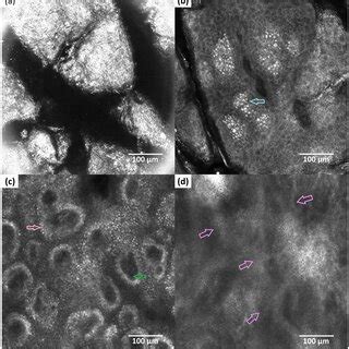 Reflectance confocal microscopy RCM images 500 500 µm of the