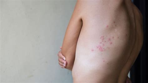 If You Had Chickenpox You May Also Develop Shingleshere S How Sharecare