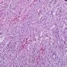 Pathology Outlines Kaposi Sarcoma Eyelid