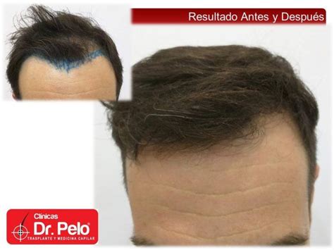injerto capilar fue 20 Clínicas Dr Pelo