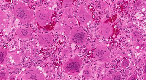 Células gigantes multinucleadas MiInformePatología ca