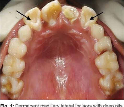 Developmental Disturbances Of Teeth Flashcards Quizlet