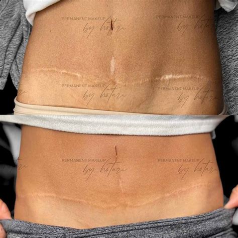 Can A Tummy Tuck Be Covered By Medicaid At Bethany Lee Blog