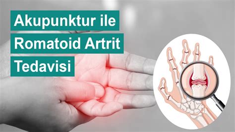 Akupunktur Ile Romatoid Artrit Tedavisi