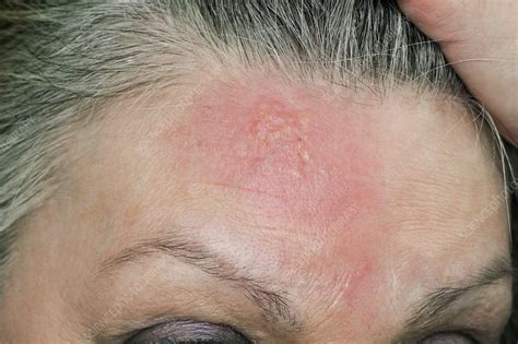 Shingles Rash On The Head Stock Image C Science Photo Library Hot Sex