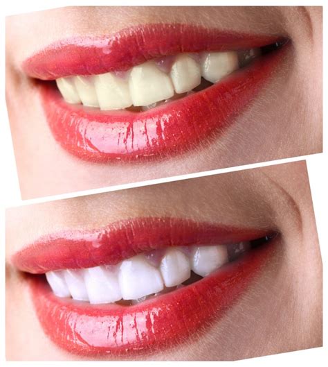 Lente De Contato Dental Antes E Depois Dr Paulo Coelho