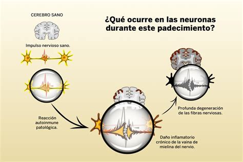 El Universo Bajo el Microscopio Esclerosis múltiple