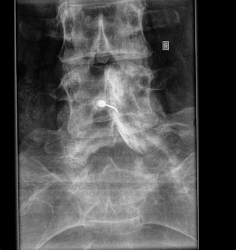 Epidurale Hopital Créteil Grand Paris