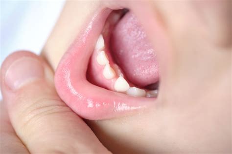 Les Dents D Finitives De Mon Enfant Poussent Derri Re Ses Dents De Lait