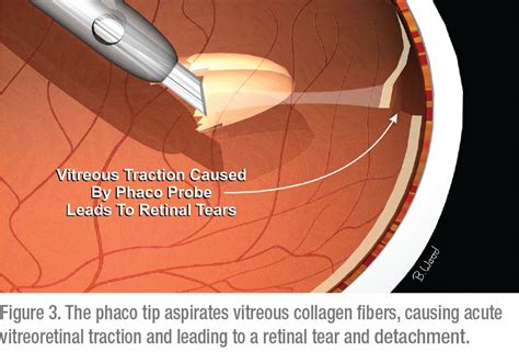 Pars Plana Vitrectomy EyeWiki