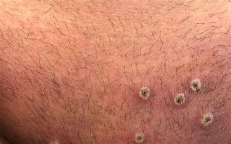 VIRUELA DEL MONO EMERGENCIA MUNDIAL Que es cómo se contagia y riesgos