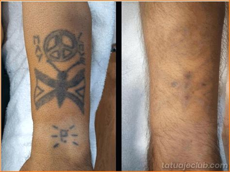 Es peligroso quitar un tatuaje láser peligros y efectos secundarios de