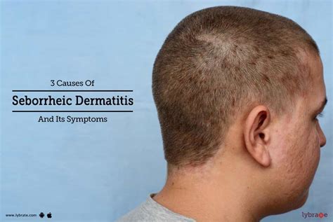 3 Causes Of Seborrheic Dermatitis And Its Symptoms By Dr Archit