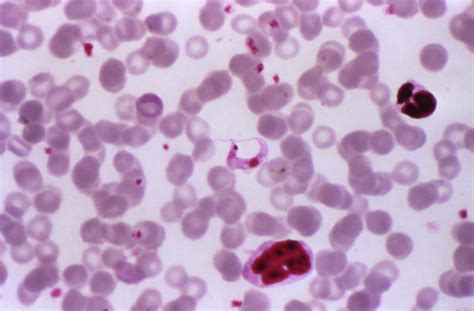 Trypanosoma Cruzi Enfermedad De Chagas Concise Medical Knowledge