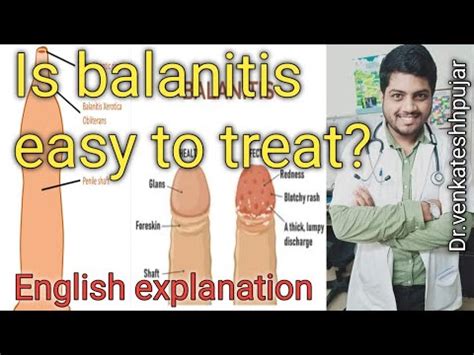 Balanitis Symptoms Causes Treatment Complications Detailed English