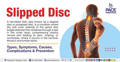 Slipped Disc Herniated Disc Causes Symptoms And Treatment