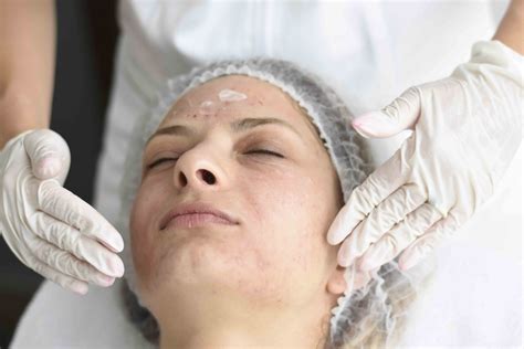 Medicamentosa Treatment Of Acne Derma Center