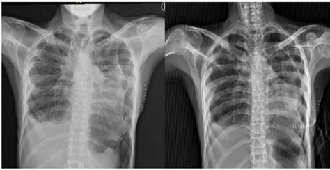 Chest Radiograph Posteroanterior View Postoperatively Showing Left