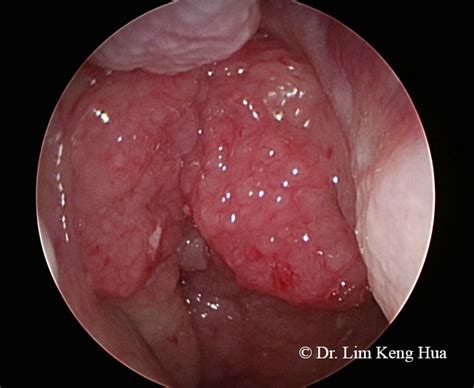 Nose Cancer Screening Dr KH Lim ENT Clinic