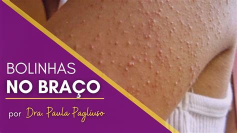 Bolinhas no braço O que fazer YouTube
