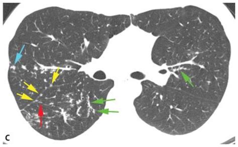 Nodular Lung Disease Radiology Key