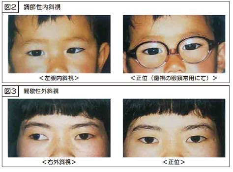 見逃しに注意！乳幼児の弱視・斜視｜健康情報利根中央病院