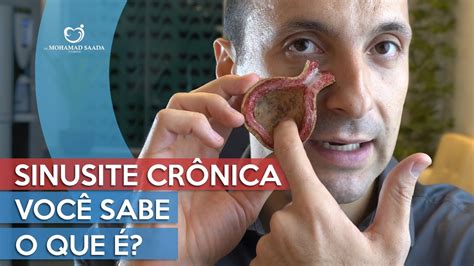 Sinusite Crônica Saiba O que é Como Tratar Sintomas e Mais YouTube