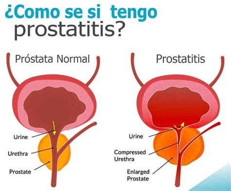 Prostatitis S Ntomas Prevenci N Y Tratamiento
