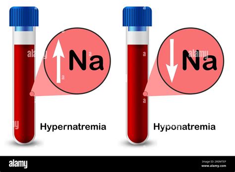 Hypernatremia And Hyponatremia With Test Sample In Test Tube 3d