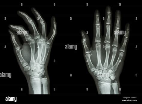 Xray Hand Anatomy