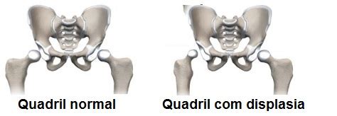 Displasia De Quadril O Que E Como Tratar Uma Perna Mais Curta Do