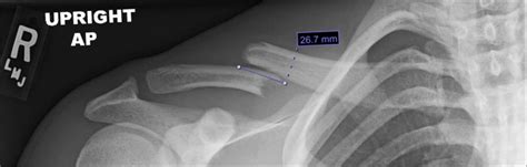 Evaluation And Management Of Midshaft Clavicle Fractures In Adolescents