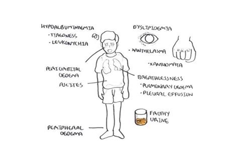 Symptoms Of Nephrotic Syndrome MEDizzy