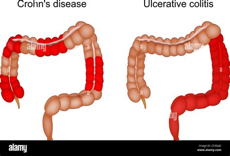 Chronische Colitis Ulcerosa Stock Vektorgrafiken Kaufen Alamy