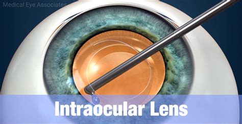 Cataract Surgery At Medical Eye Associates Medical Eye Associates