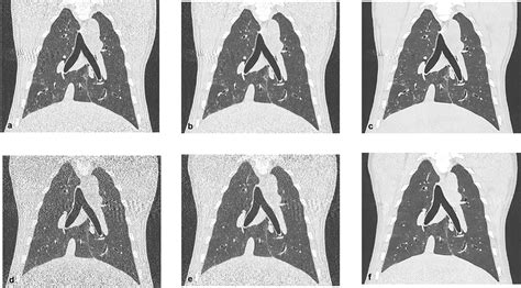 basics of iterative reconstruction methods in computed tomography a vendor independent overview