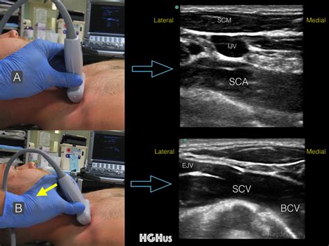 Supraclavicular Subclavian Highland EM Ultrasound Fueled Pain Management