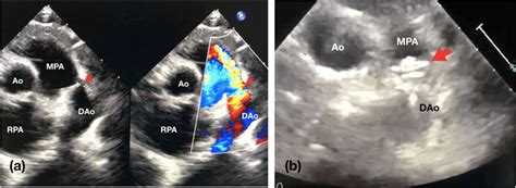 A A 9 Mm Patent Ductus Arteriosus PDA Shown By Transesophageal