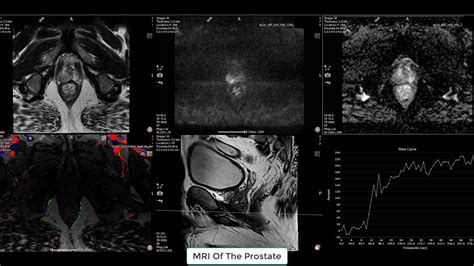 MRI Of The Prostate MULTIPARAMETRIC MRI OF THE PROSTATE YouTube