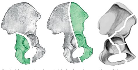 Fracture Of Both Columns Semantic Scholar