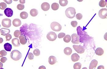 Anomalies Abnormalities Disorders Rbc Wbc Platelets Flashcards