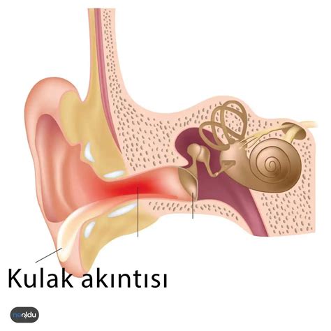 Kulak Akıntısı Nedir ve Neden Olur Tedavisi Nasıldır