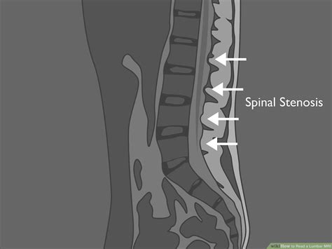 Healthcare Extreme How To Read An MRI Lumbar Spine In Easy 53 OFF