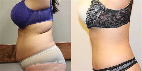 Tummy Tuck Abdominoplasty Before And After Photos Dr Anzarut