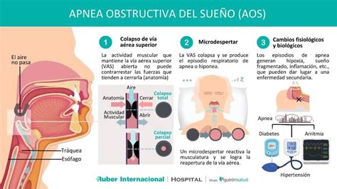 La apnea del sueño cómo afecta a nuestra salud