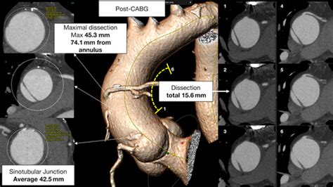 Managing Iatrogenic Aortic Dissection Insight From D Holographic
