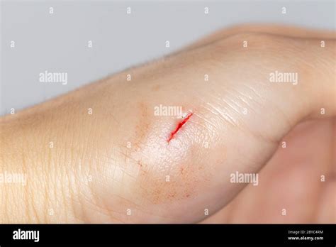 Knife Cuts On Body