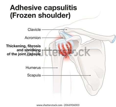 Frozen Shoulder Adhesive Capsulitis Labeled Illustration Stock
