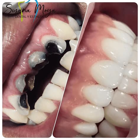Antes y después diseño de sonrisa de Susana Moya Dental y Esthetic Clinic